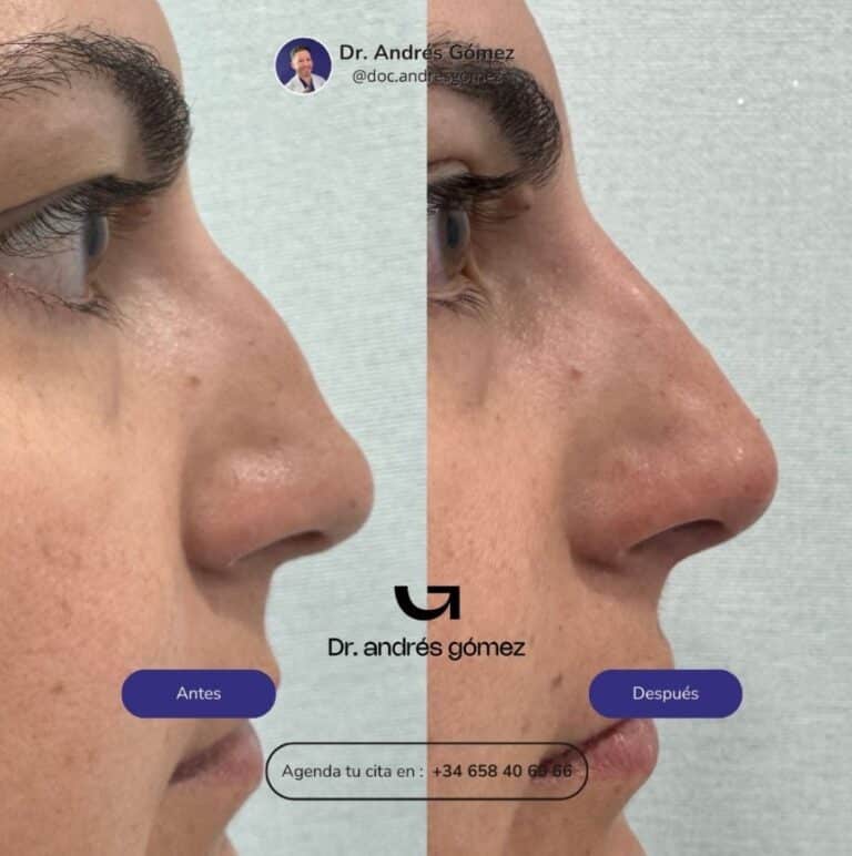Rinomodelación en Madrid Con Ácido Hialurónico: ¡Sin Cirugía! - doctorandresgomez.com